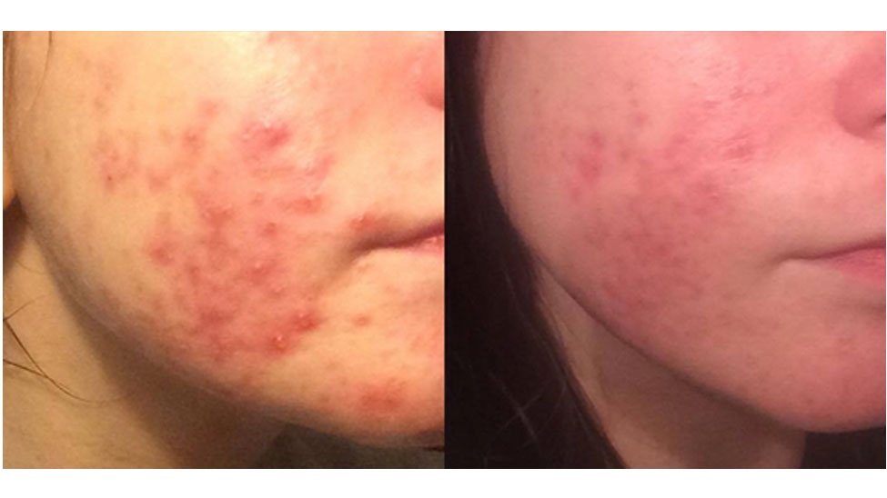 BBC News - Acne Needs to be Taken More Seriously say Charities ...