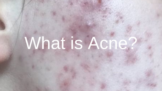 What is Acne? – SkinGenius Skincare