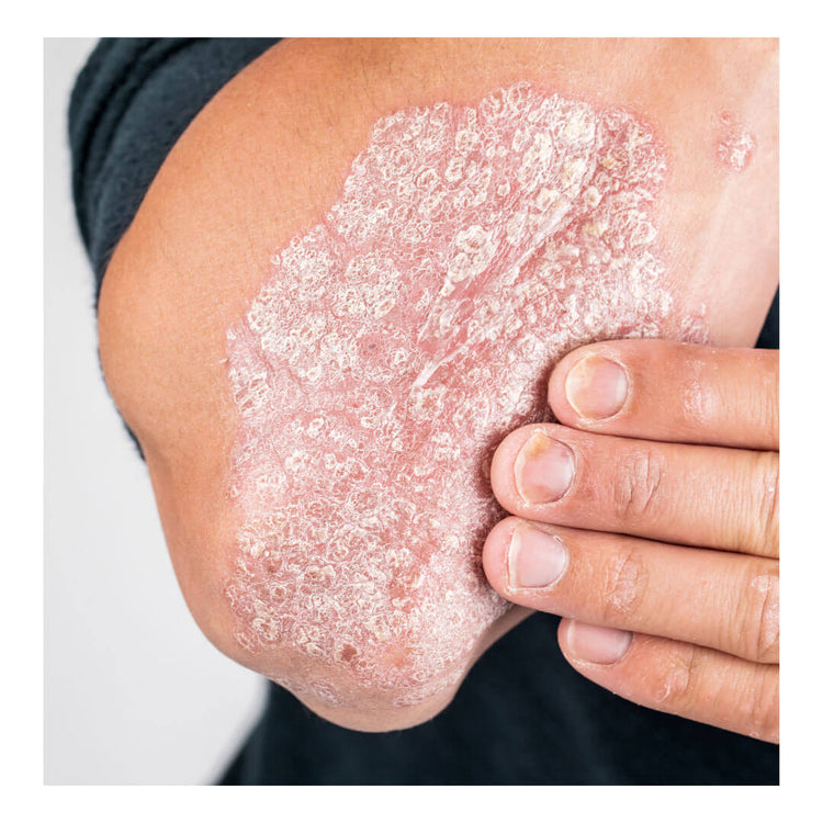 What is Eczema & Psoriasis and How to Help | Skin:Genius – SkinGenius ...